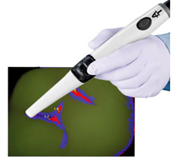 Laser Cavity Finder | Anthony Scianni, D.M.D.
